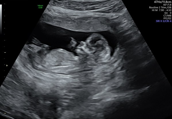 Pregnancy After Breast Cancer Bri D Pt